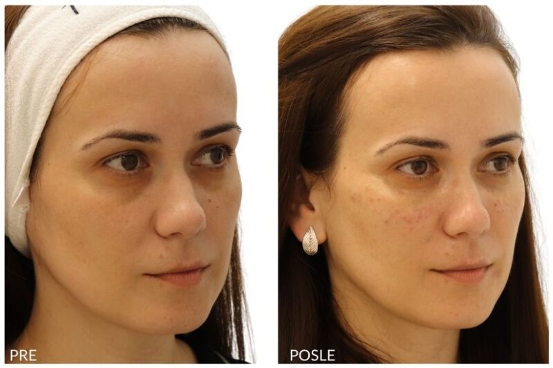 Hijaluronski fileri - tretman, efekti, cena? | IMedic ordinacija