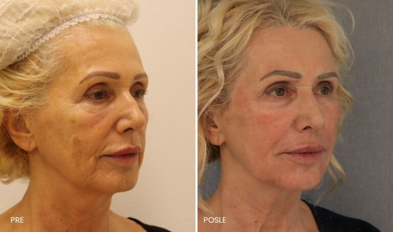 PRE I POSLE | Estetski i antiage tretmani | IMedic ordinacija