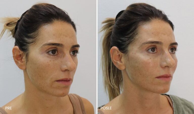 PRE I POSLE | Estetski i antiage tretmani | IMedic ordinacija