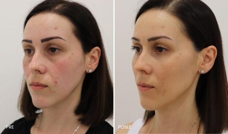 PRE I POSLE | Estetski i antiage tretmani | IMedic ordinacija